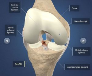 The Do's and Don'ts After ACL & MCL Tears & Surgery | Heiden Orthopedics