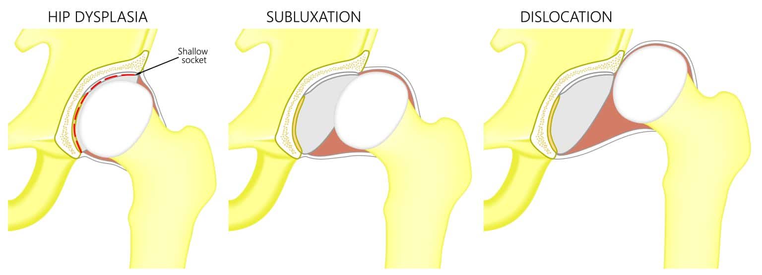 Hip Dislocation Symptoms Treatment And Recovery Heiden Orthopedics