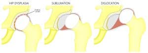 Hip Dislocation: Symptoms, Treatment, & Recovery - Heiden Orthopedics