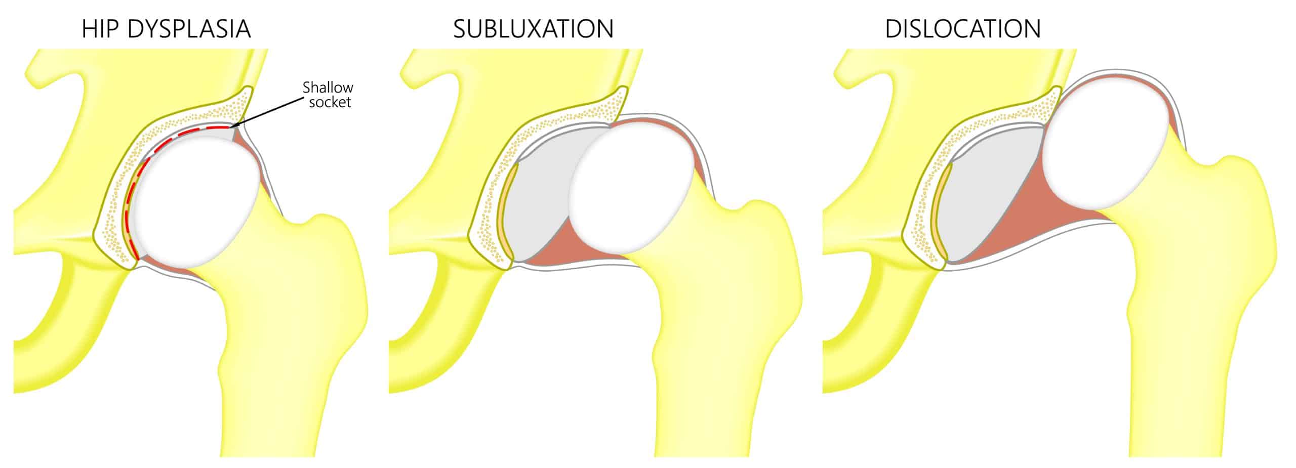 Hip Dislocation: Symptoms, Treatment, & Recovery - Heiden Orthopedics