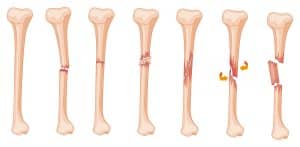 Tibia Fractures: Types, Symptoms, & Treatments - Heiden Orthopedics