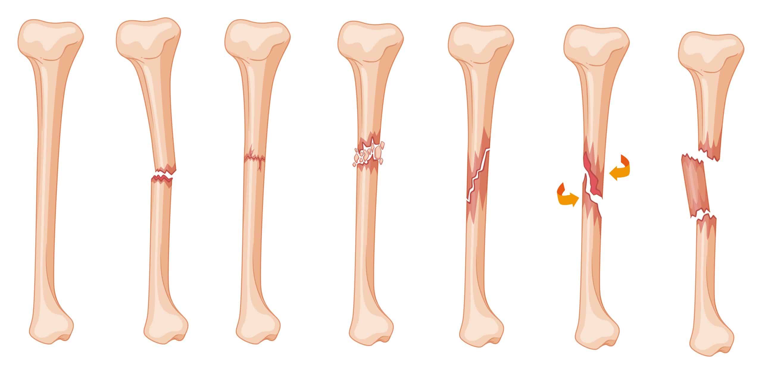 Tibia Fractures: Types, Symptoms, & Treatments - Heiden Orthopedics