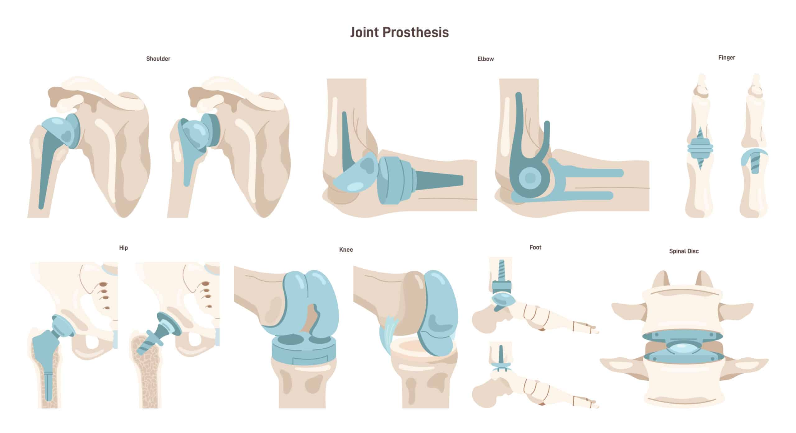 Total Joint Replacement - Heiden Orthopedics