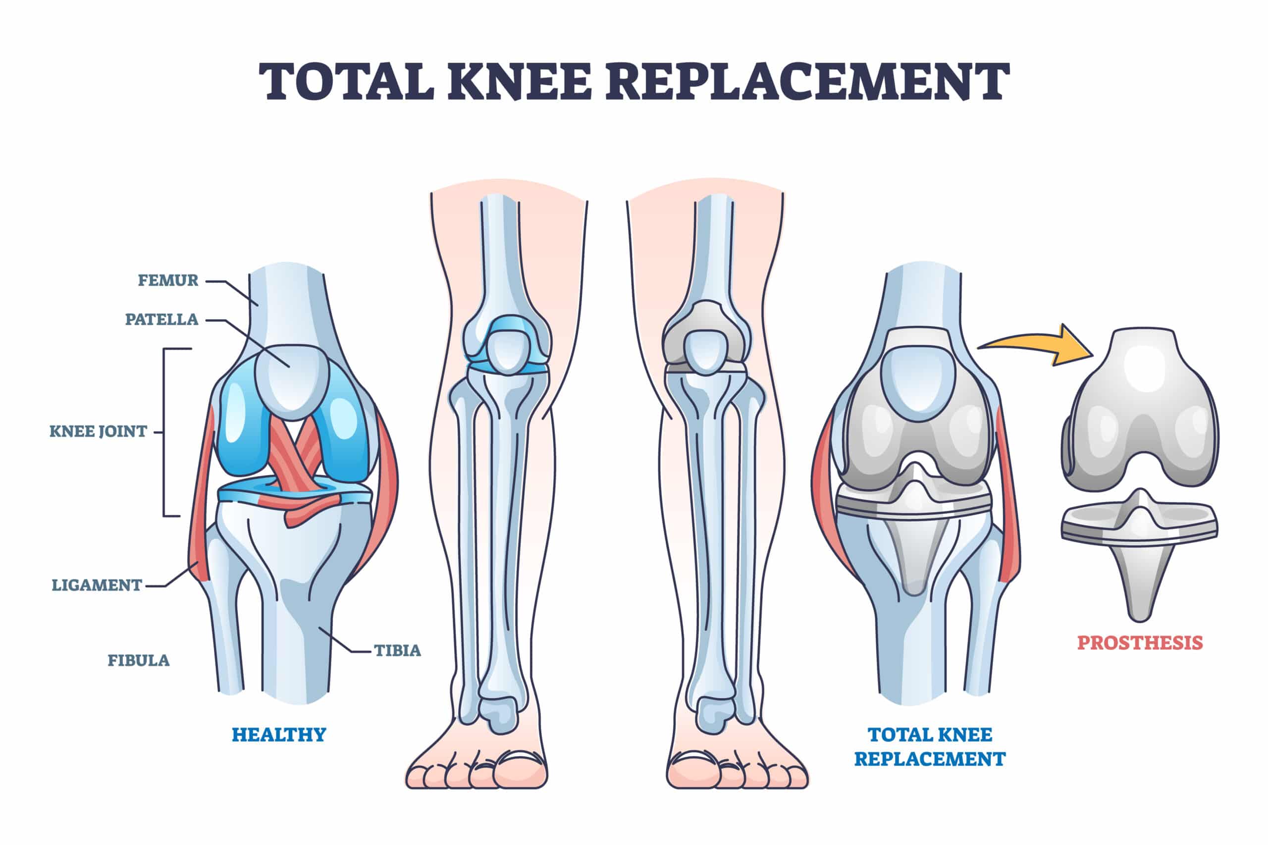 What To Expect 1 Year After Total Knee Replacement - Heiden Orthopedics