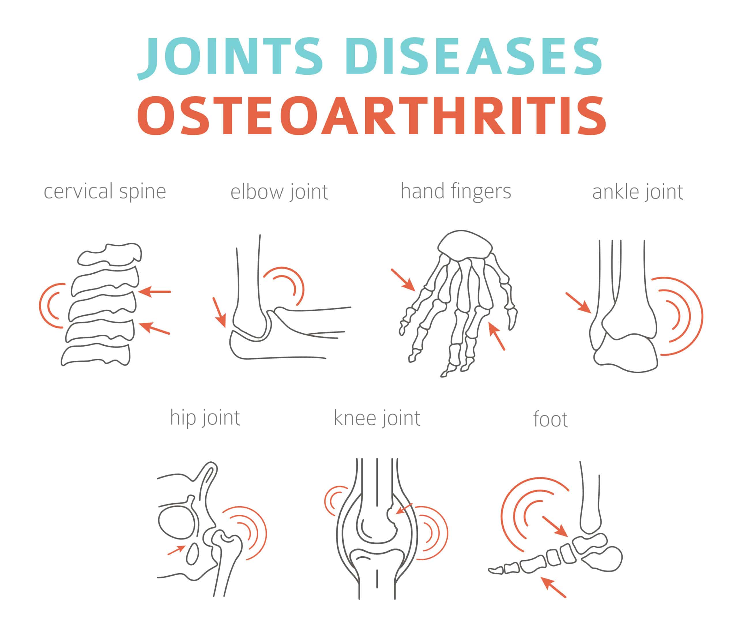 Osteoarthritis Surgery and Joint Replacement - Heiden Orthopedics